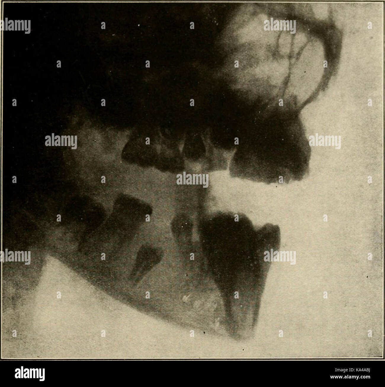 Elementare und dentale radiographie von howard riley raper 1918 -Fotos ...