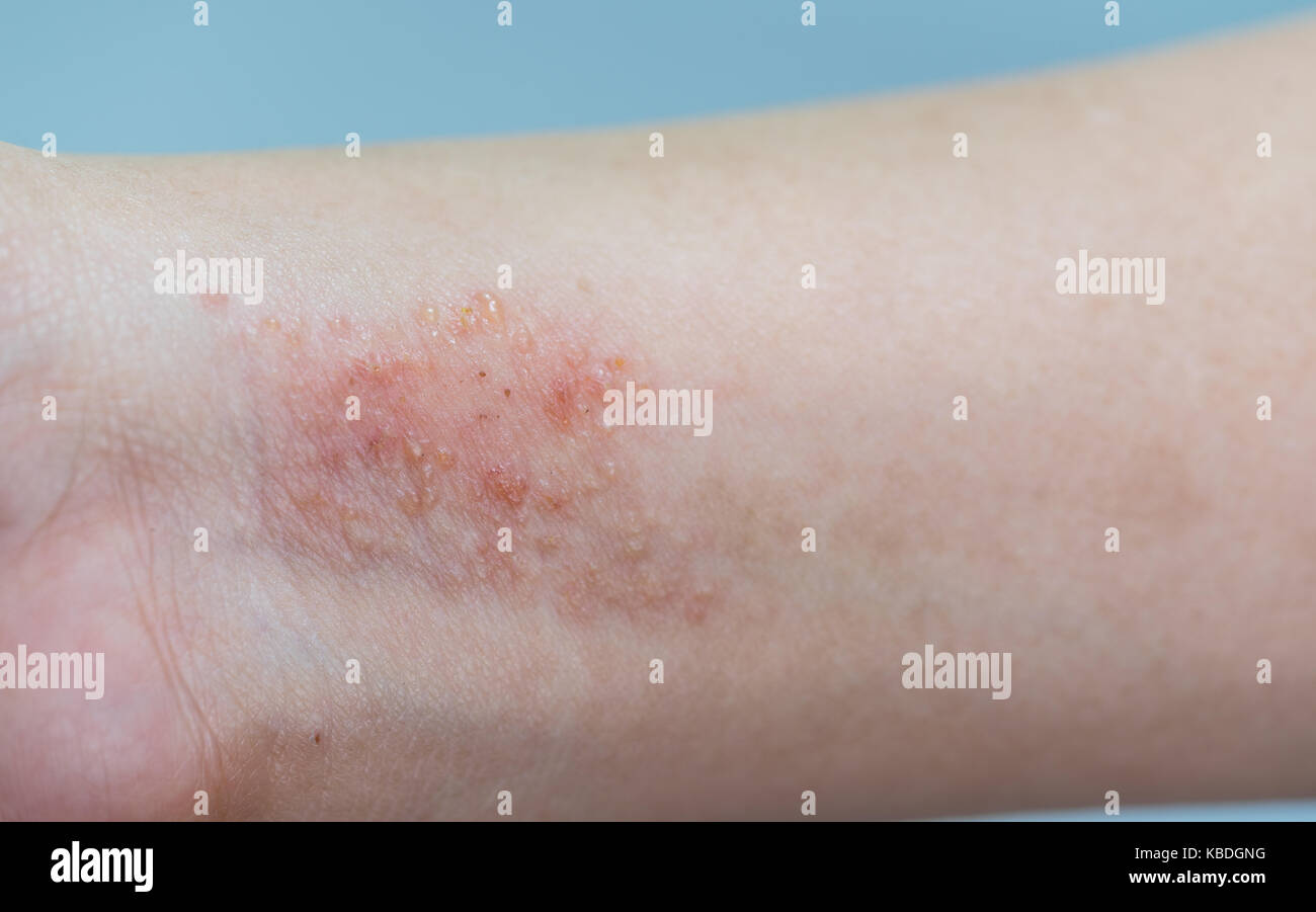 Atopische Dermatitis symptom Haut auf der Hand Stockfotografie - Alamy