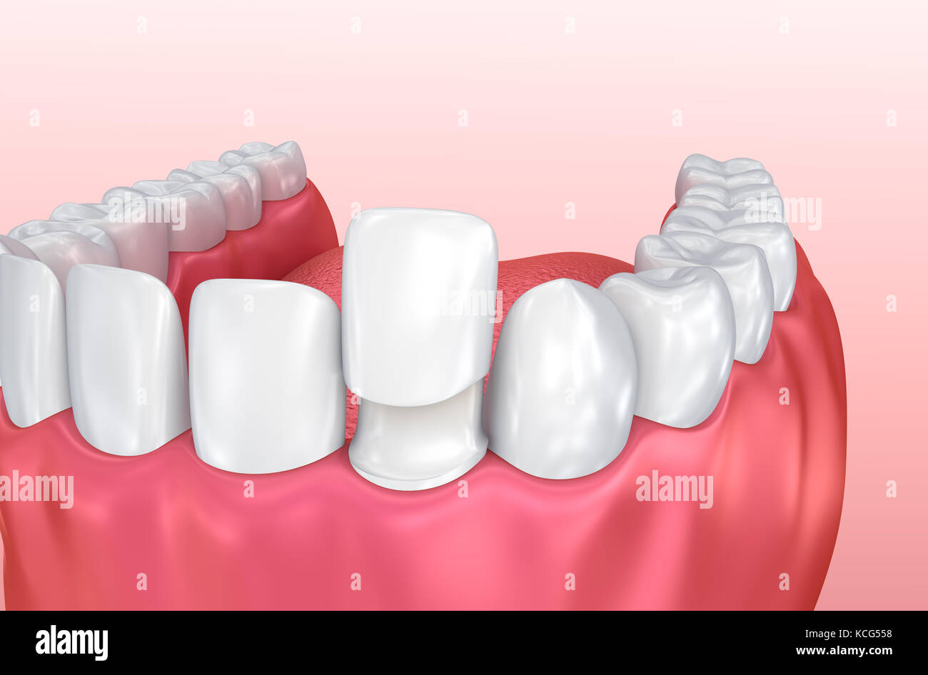 Dental Veneers: Porzellan furnier Installation. 3D-Darstellung ...