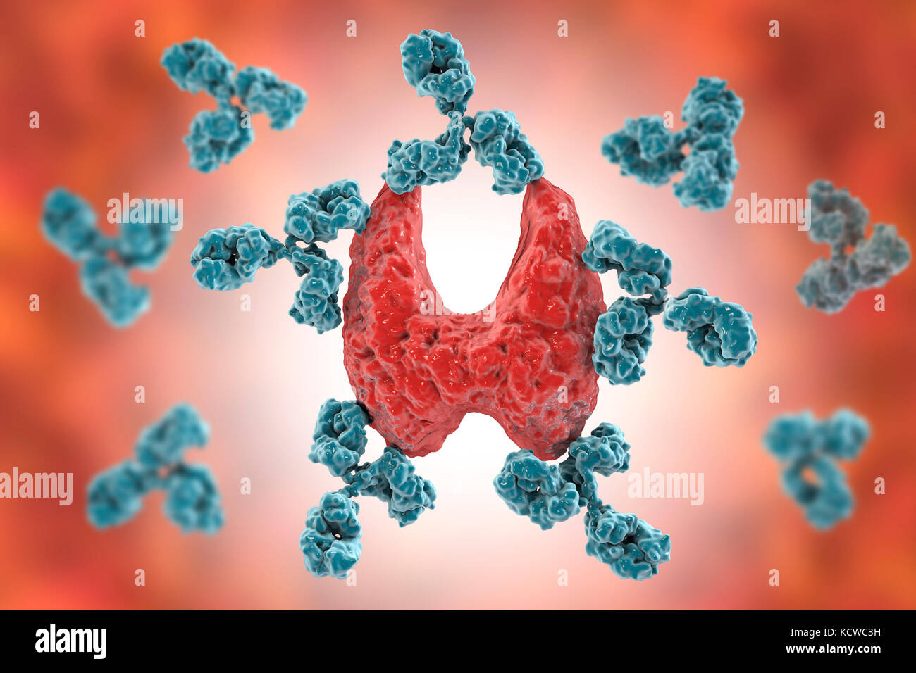 Autoimmune Thyreoiditis (Hashimoto- Thyreoiditis), konzeptionelle ...