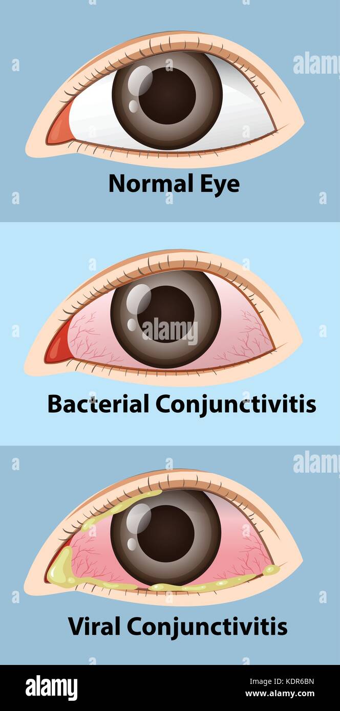 Verschiedene Stufen der Bindehautentzündung im menschlichen Auge ...