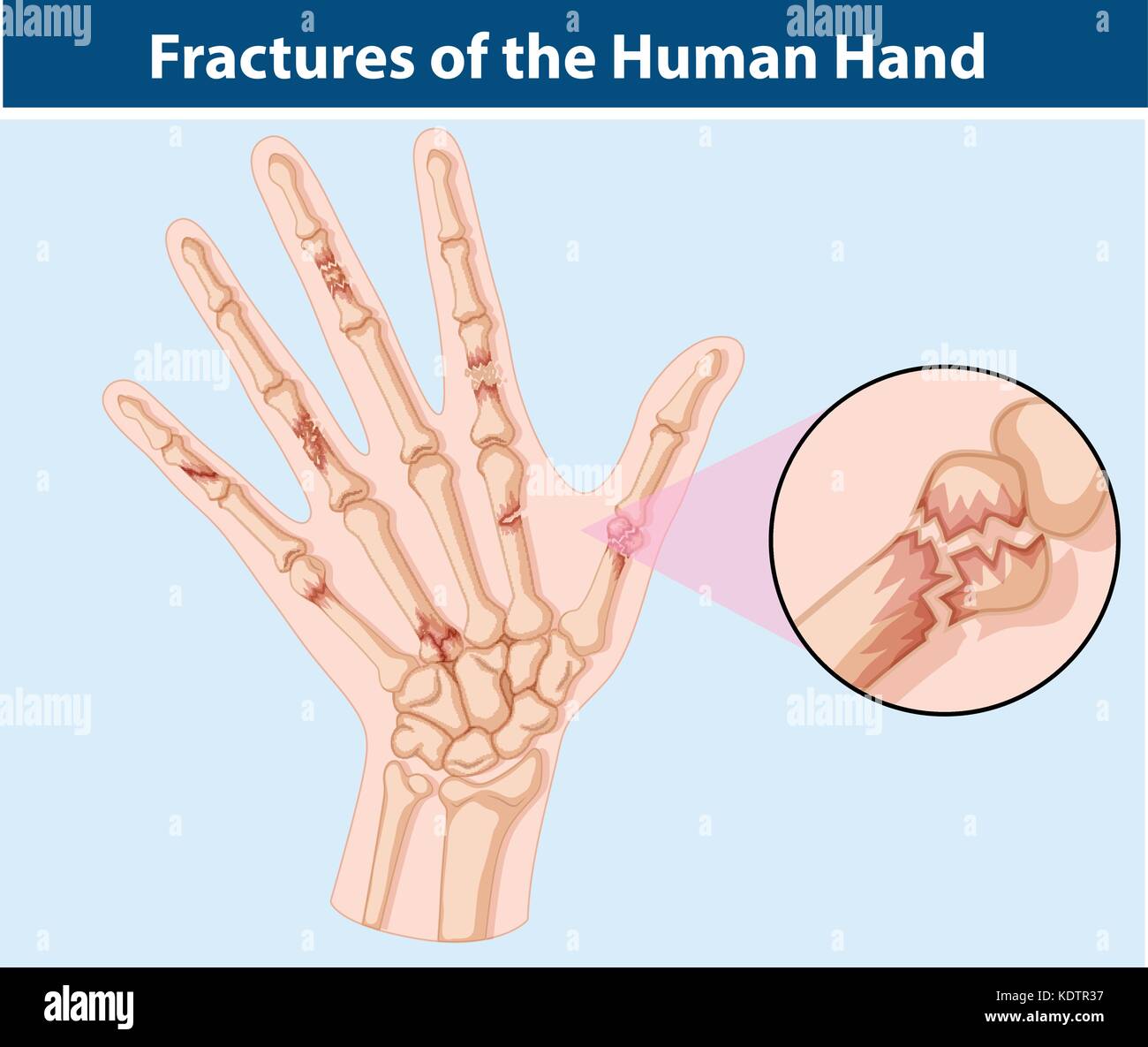 Diagramm der Frakturen in der menschlichen Hand Abbildung Stock ...