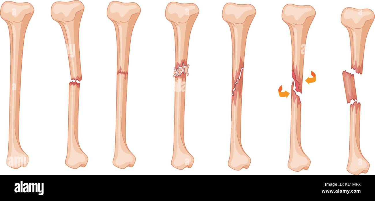 Diagramm der Bein Bruch in verschiedenen Stufen Abbildung Stock ...