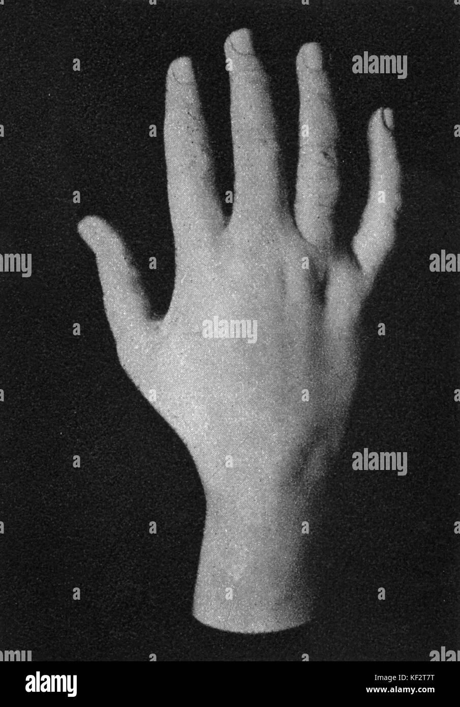 Clara Schumanns hand-Gips. Hinweis vierten Finger. Deutsche Pianist, 13 ...