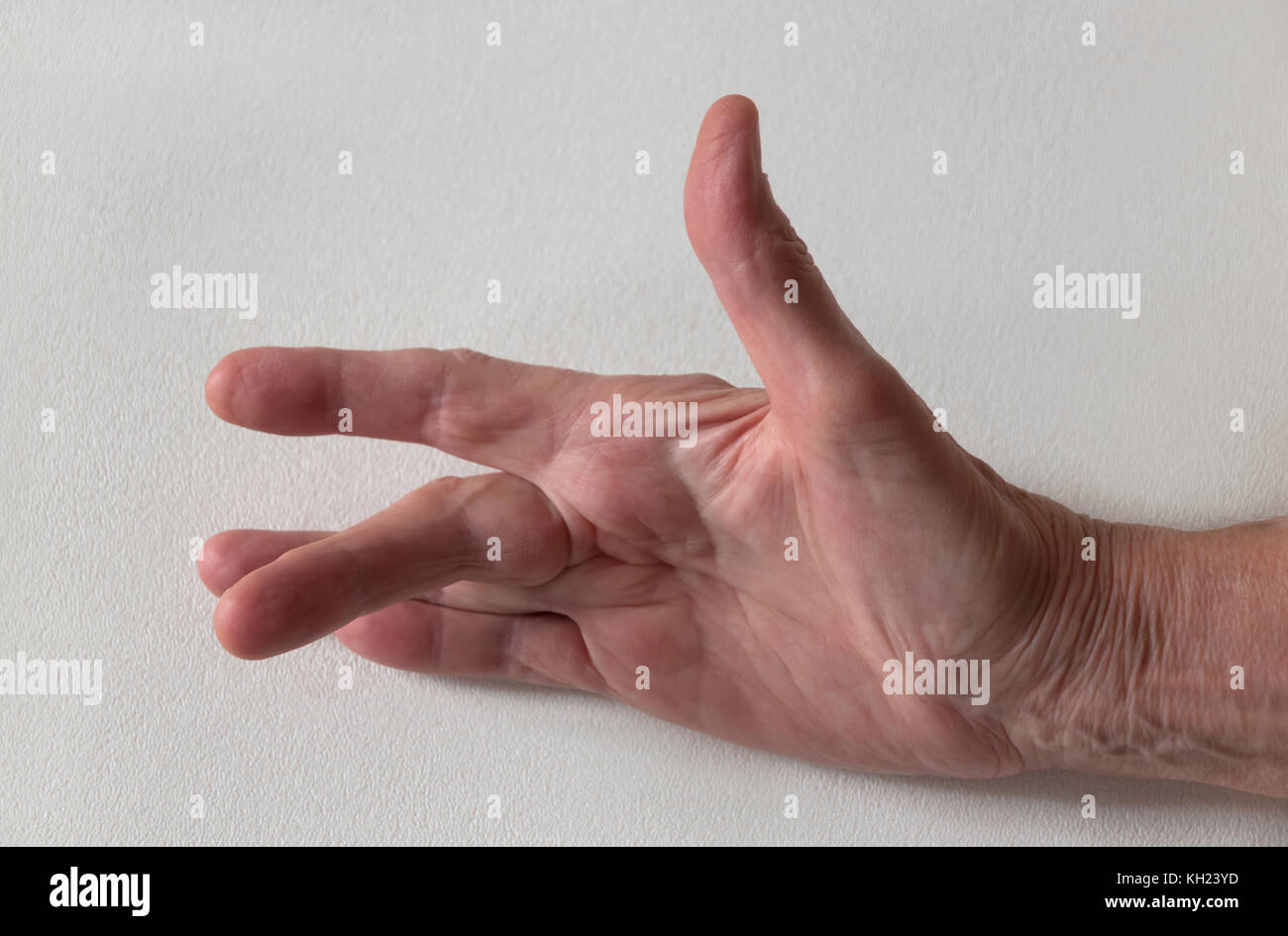 Dupuytren Kontraktur der Deformität: eine Schnur in der Hand (mit einem ...