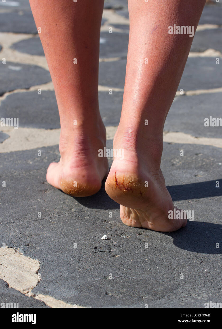 Hässliche Füße Stockfotos und -bilder Kaufen - Alamy