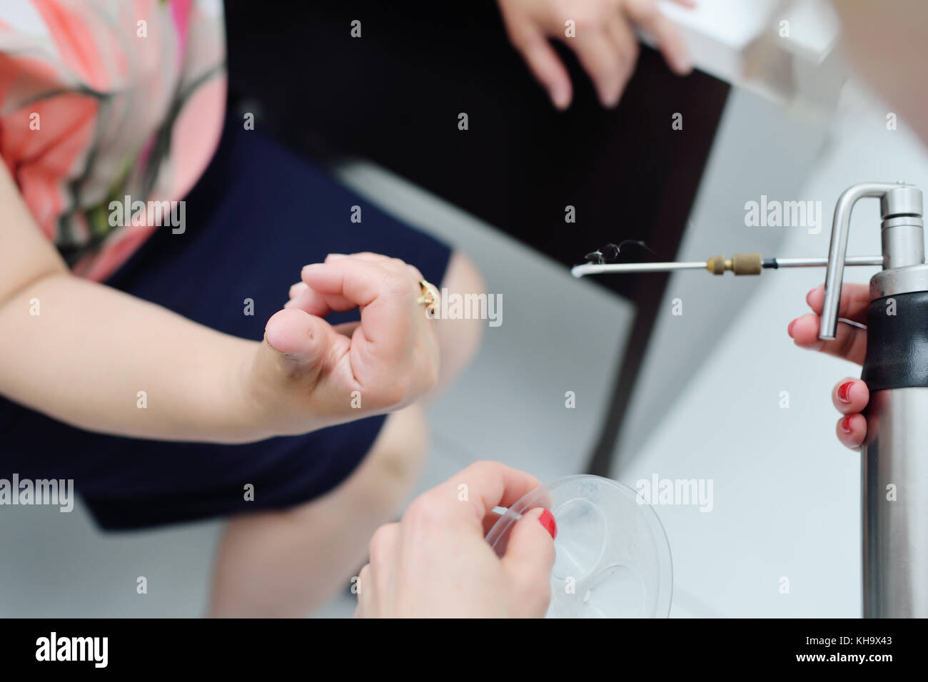 Der Hautarzt entfernt die Warze am Finger des Patienten Stockfotografie ...