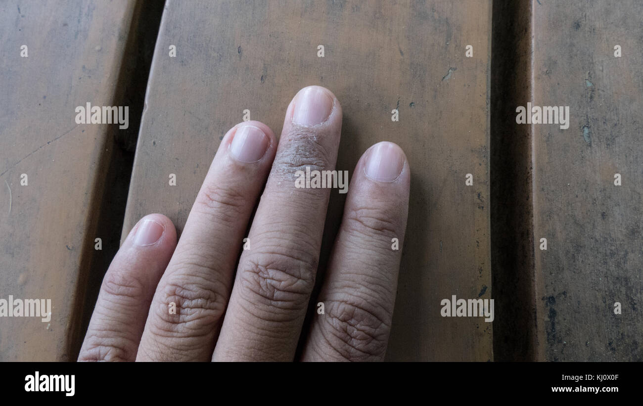 Psoriasis vulgaris, Pilz, Ekzem auf weiblichen Finger. Hautausschlag ...