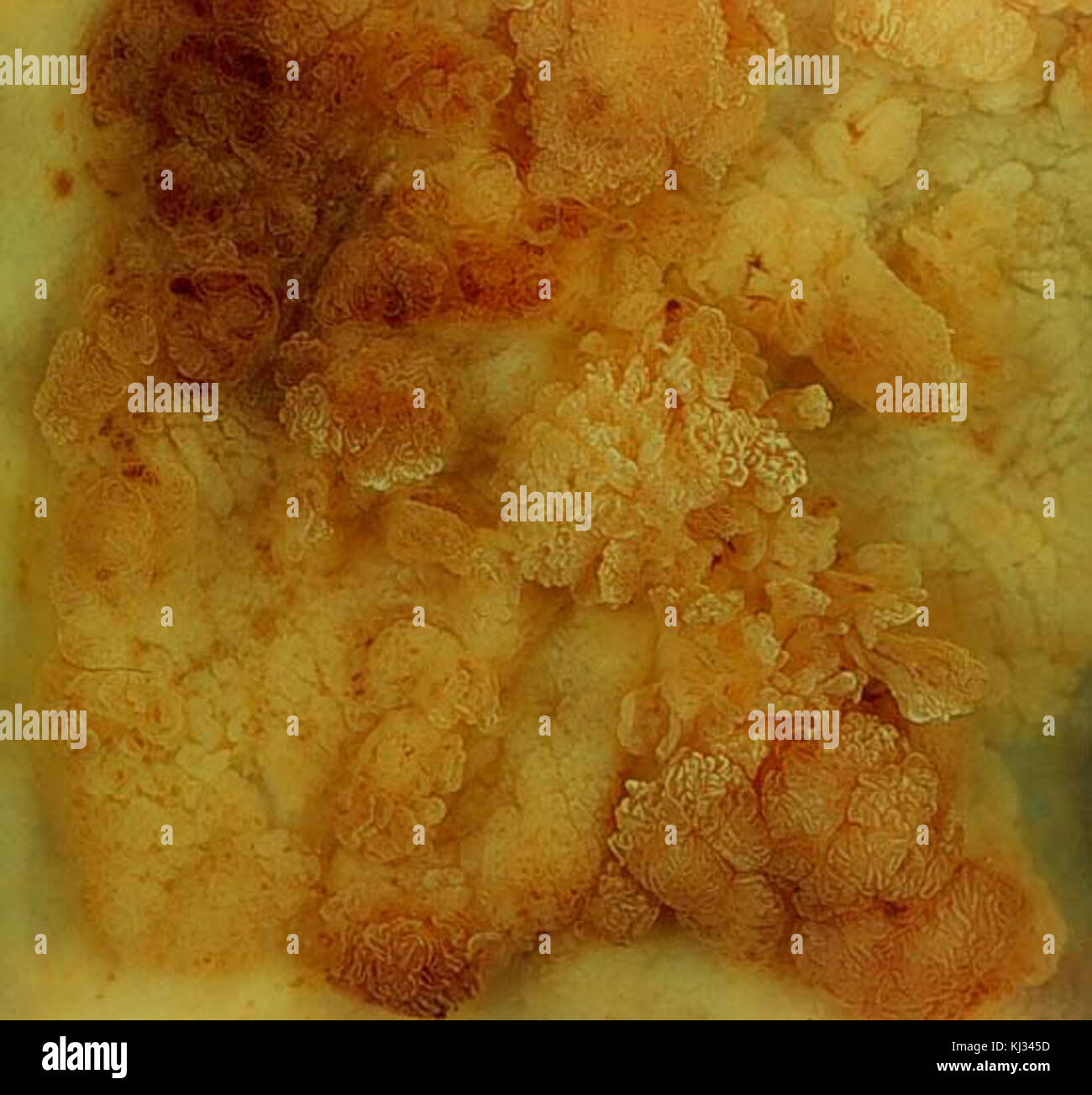 Sigmoid colon -Fotos und -Bildmaterial in hoher Auflösung – Alamy