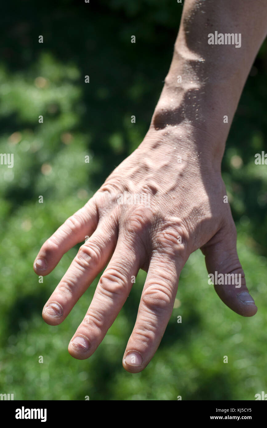 Kranke nägel -Fotos und -Bildmaterial in hoher Auflösung – Alamy