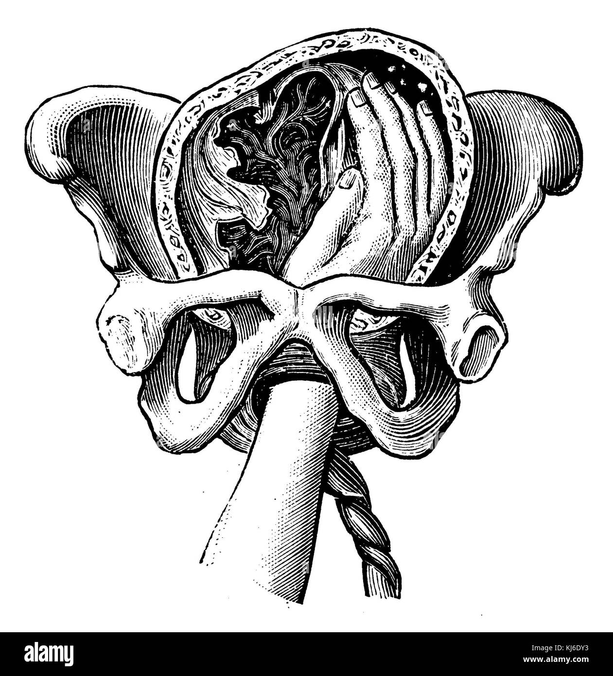 Gebärmutter entfernung Schwarzweiß-Stockfotos und -bilder - Alamy