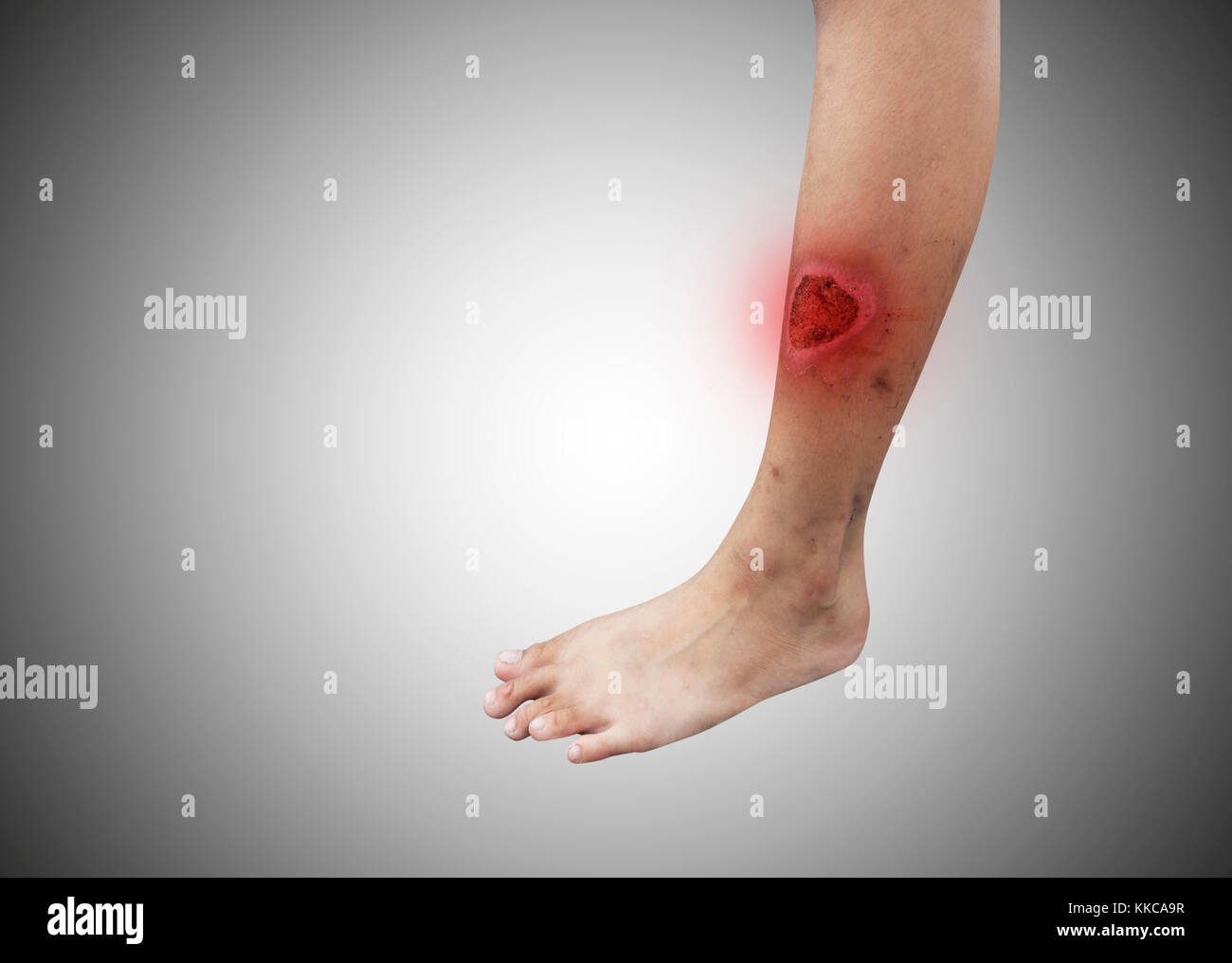 Offene Fleischwunde Stockfotos und -bilder Kaufen - Alamy