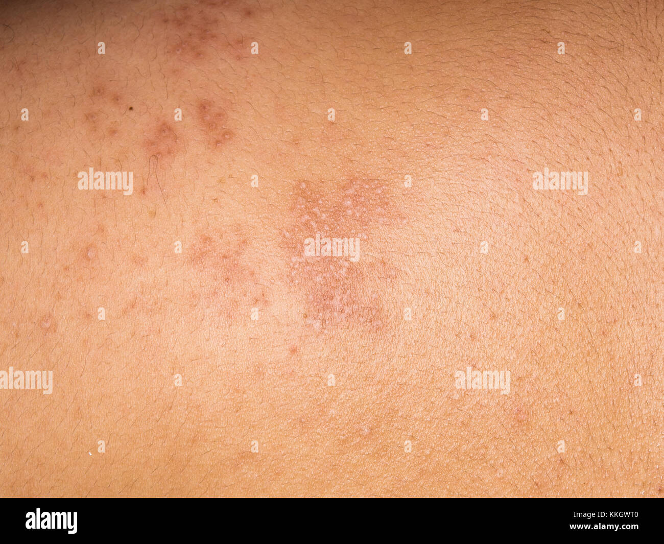 Herpes Zoster Stockfotos und -bilder Kaufen - Alamy