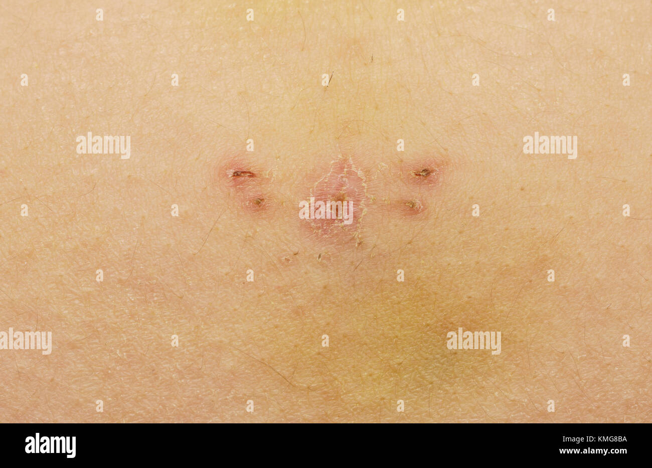 Stitches disease -Fotos und -Bildmaterial in hoher Auflösung – Alamy