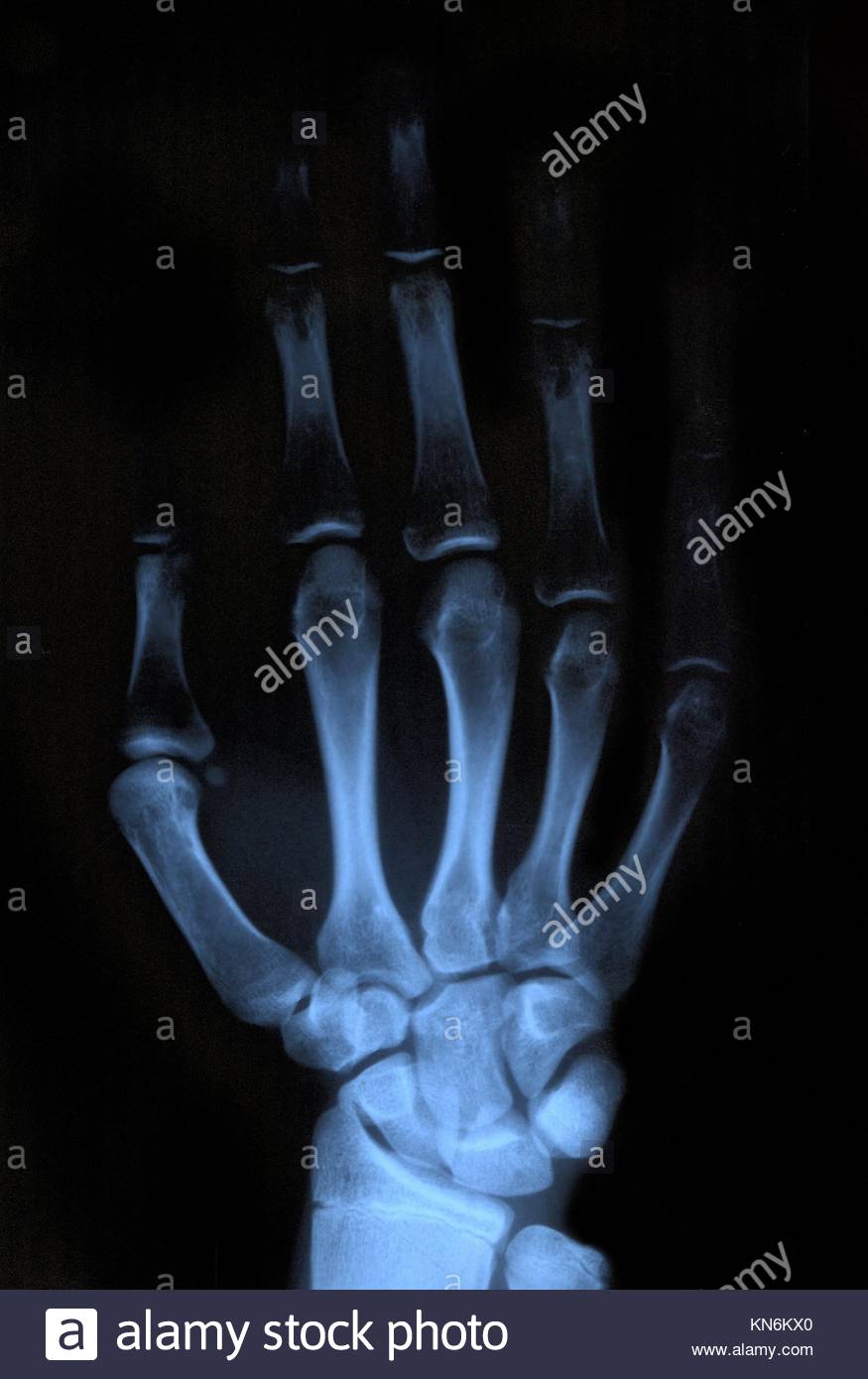 Fractured Hand X Ray Stockfotos & Fractured Hand X Ray Bilder - Alamy