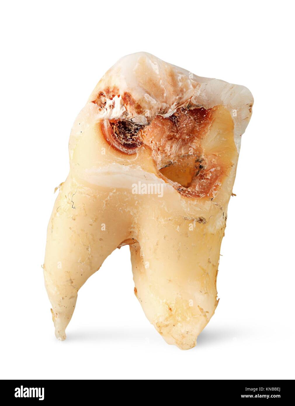 Backenzahn karies Ausgeschnittene Stockfotos und -bilder - Alamy