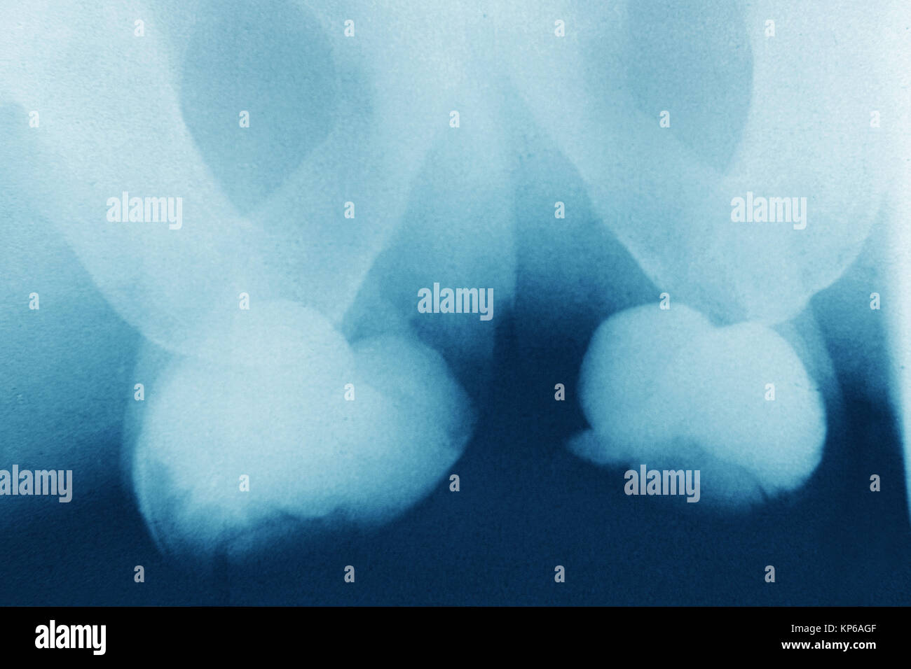 Nebenhoden Zyste, X-RAY Stockfotografie - Alamy