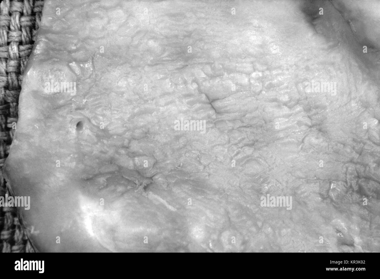 Syphilitische aortitis -Fotos und -Bildmaterial in hoher Auflösung – Alamy