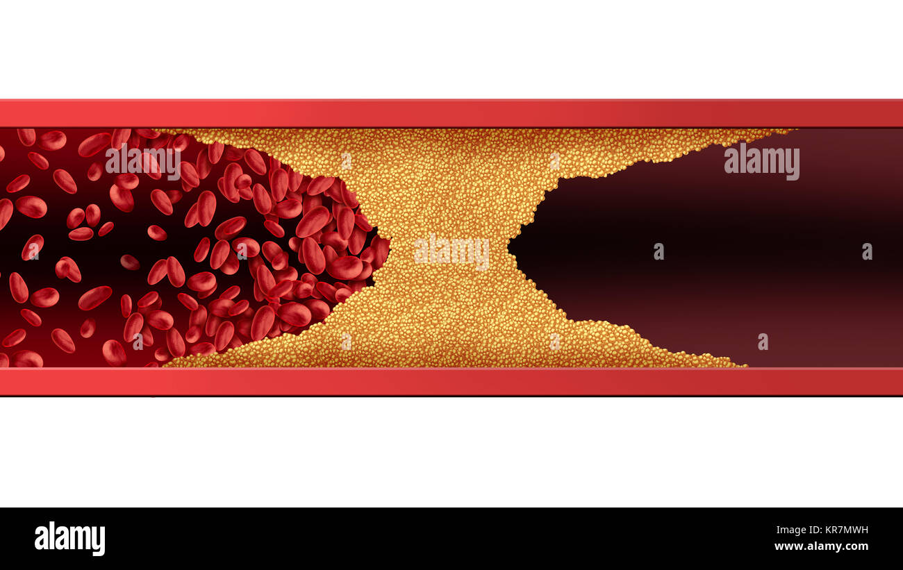 Verstopfte arterie -Fotos und -Bildmaterial in hoher Auflösung – Alamy