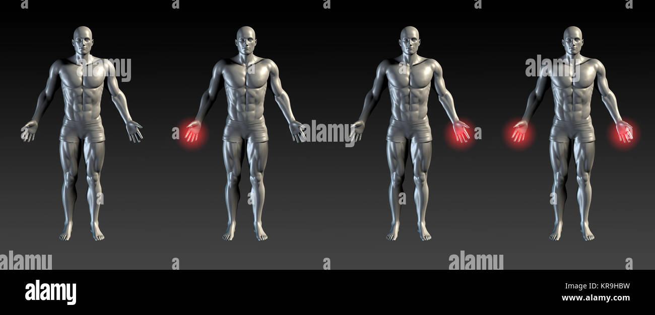 Arthritis hands xray -Fotos und -Bildmaterial in hoher Auflösung – Alamy
