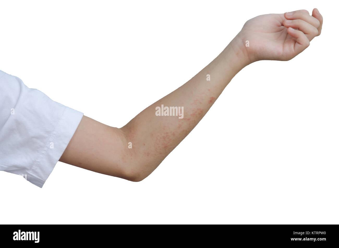 Ausschlag und die Haut an Armen, auf weißem Hintergrund Stockfotografie ...