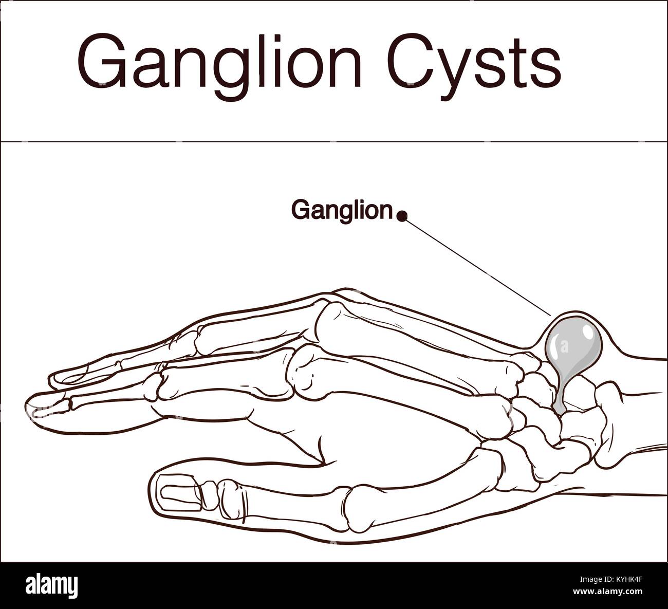 Ganglion zyste -Fotos und -Bildmaterial in hoher Auflösung – Alamy