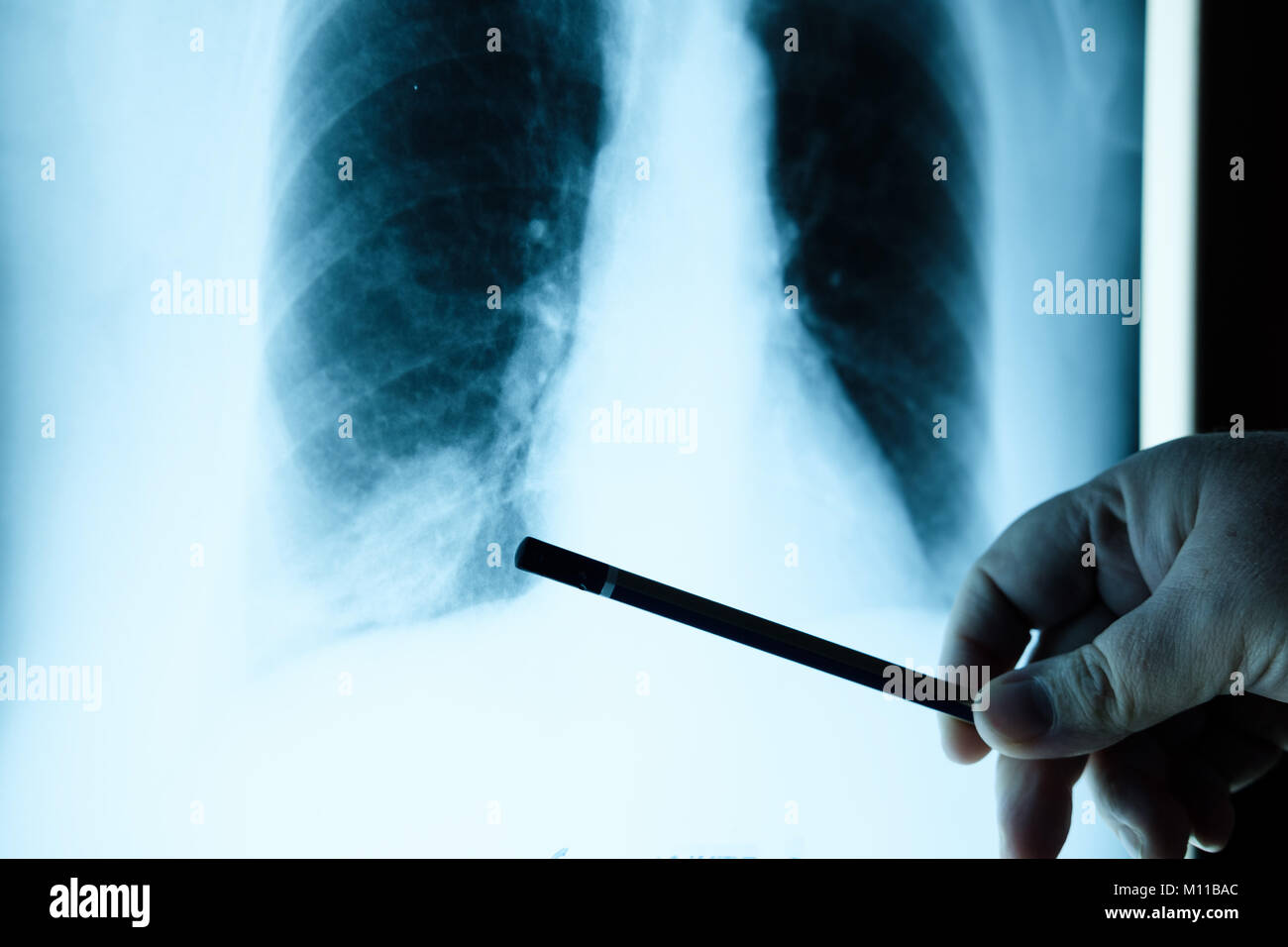 Bronchitis radiography -Fotos und -Bildmaterial in hoher Auflösung – Alamy