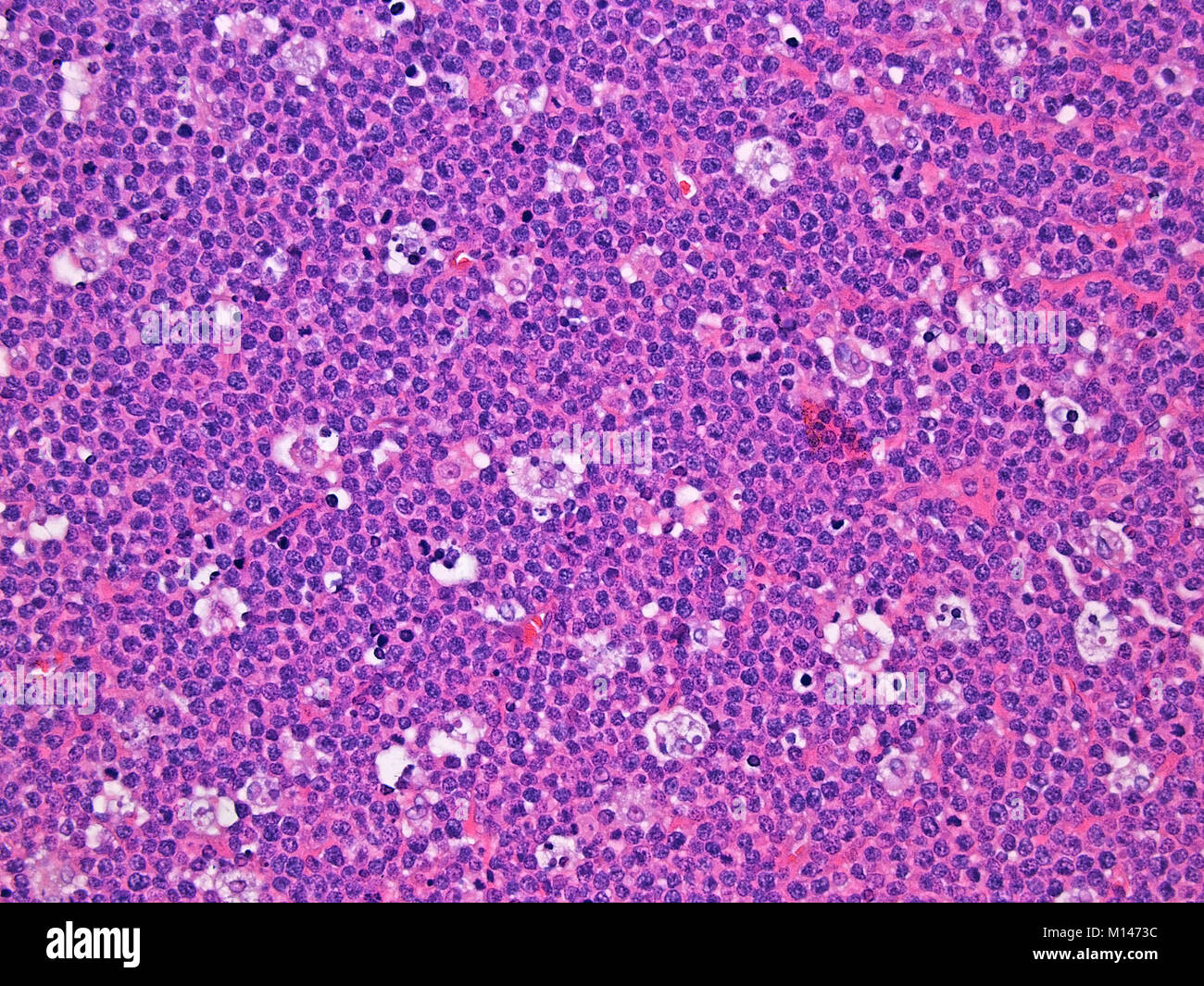 Burkitt lymphom -Fotos und -Bildmaterial in hoher Auflösung – Alamy
