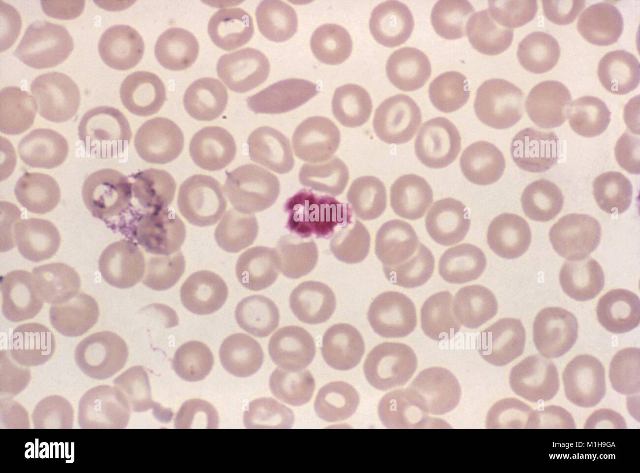 Malaria schizont Verklumpen der Blutplättchen im Blut mit Giemsa Fleck ...