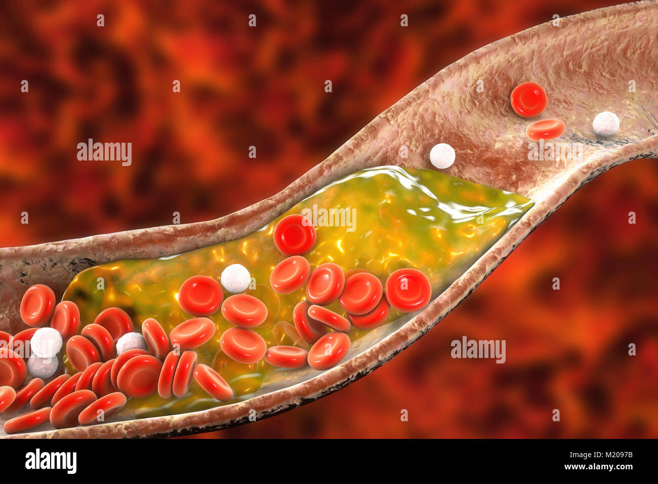 Atheromatous Plakette im Blutgefäß, Computer Bild. Ein Atherom ...