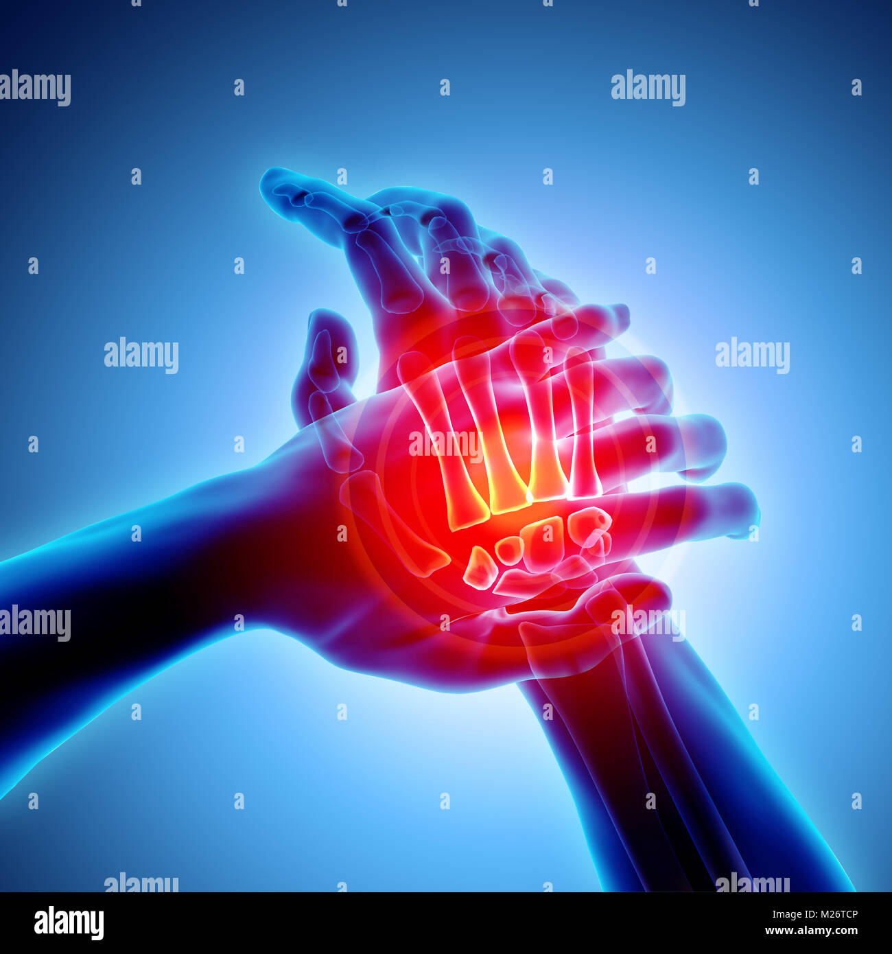 3D-Darstellung von Palm schmerzhaft - Skelett Röntgen, medizinische ...