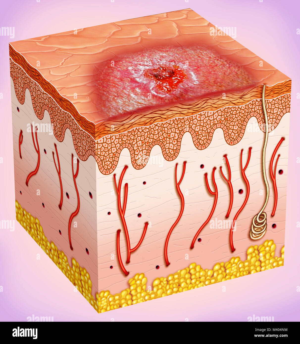 Karzinom Stockfotos und -bilder Kaufen - Alamy