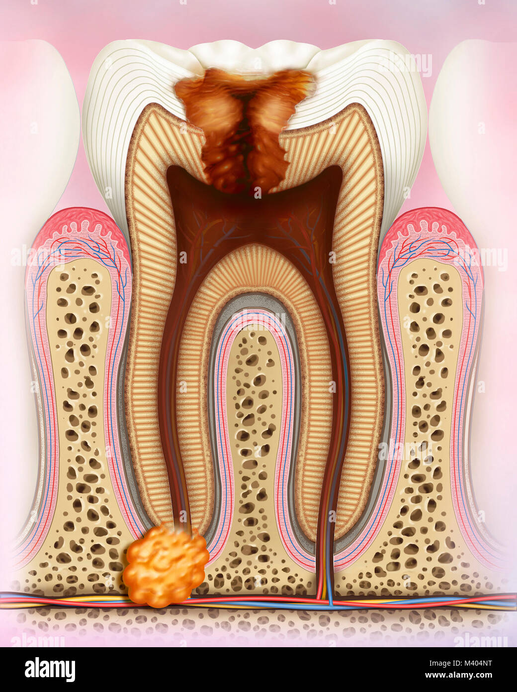 Dental caries images -Fotos und -Bildmaterial in hoher Auflösung – Alamy