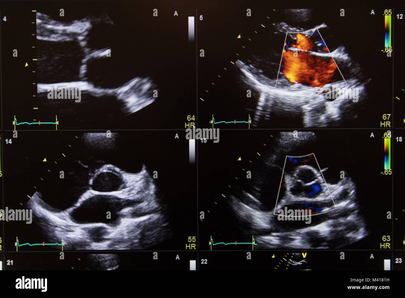 Herz ultraschall -Fotos und -Bildmaterial in hoher Auflösung – Alamy
