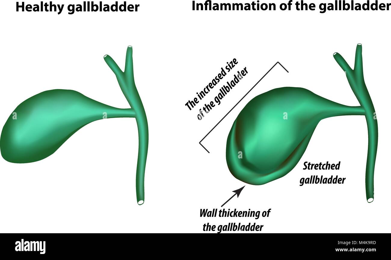 Symptome einer Entzündung der Gallenblase. Cholezystitis. Verdickung ...