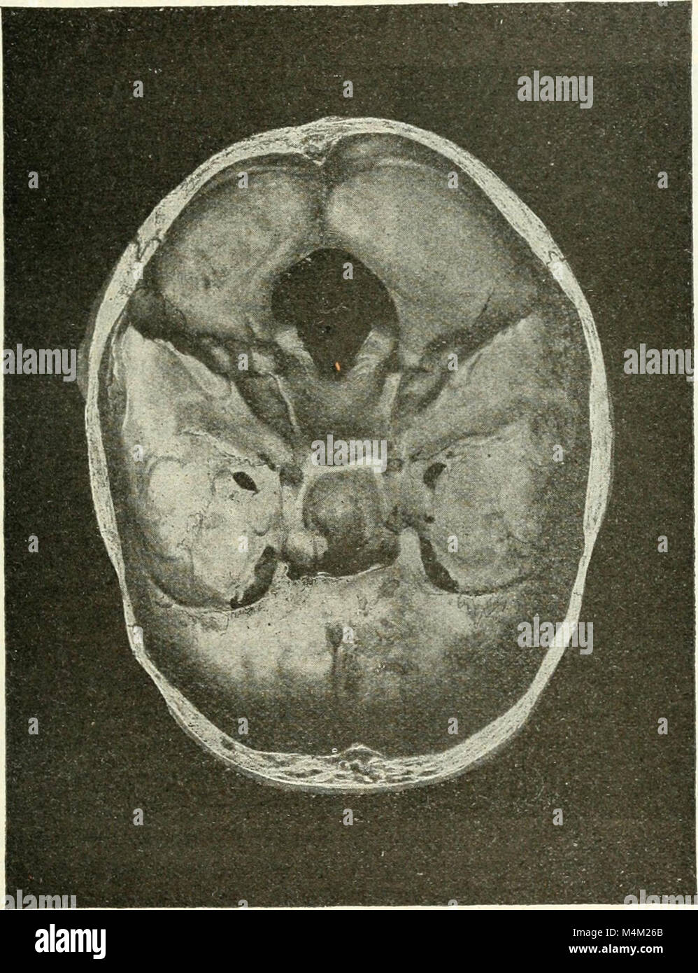 Akromegalie -Fotos und -Bildmaterial in hoher Auflösung – Alamy