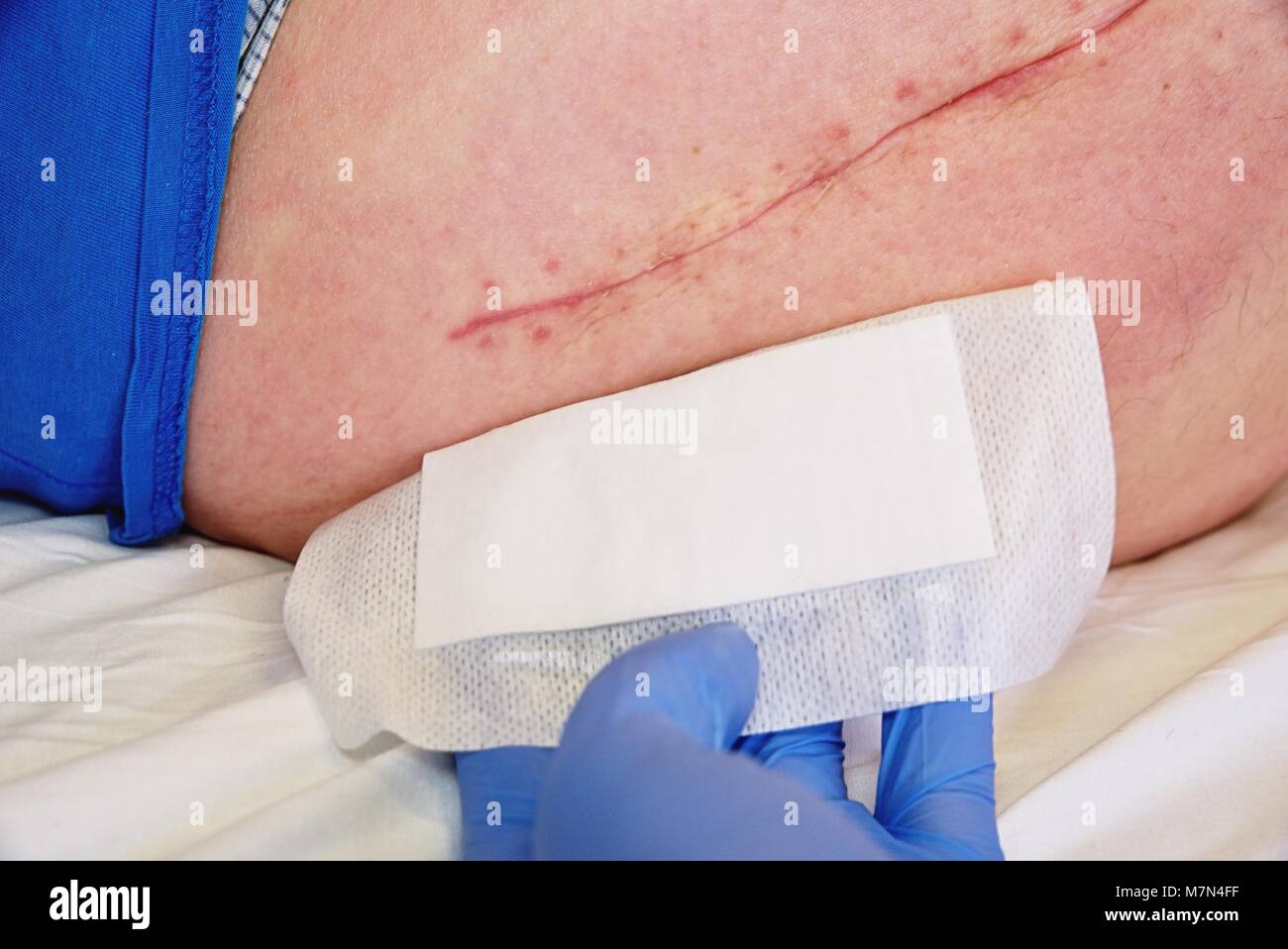 Wunde auf der Haut. Körper mit collarbone Verletzung. Das operative ...