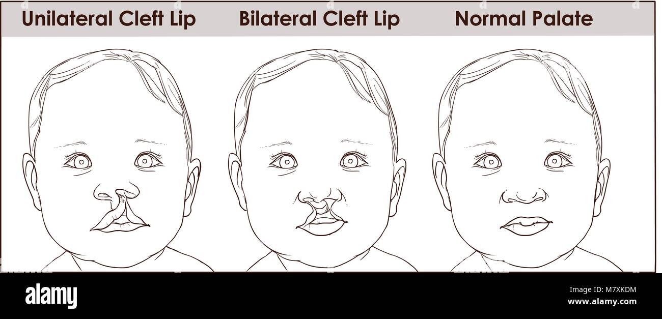 Cleft palate -Fotos und -Bildmaterial in hoher Auflösung – Alamy