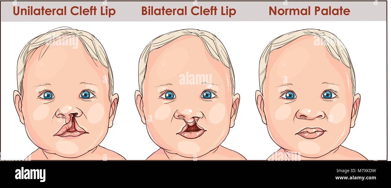 Cleft palate -Fotos und -Bildmaterial in hoher Auflösung – Alamy