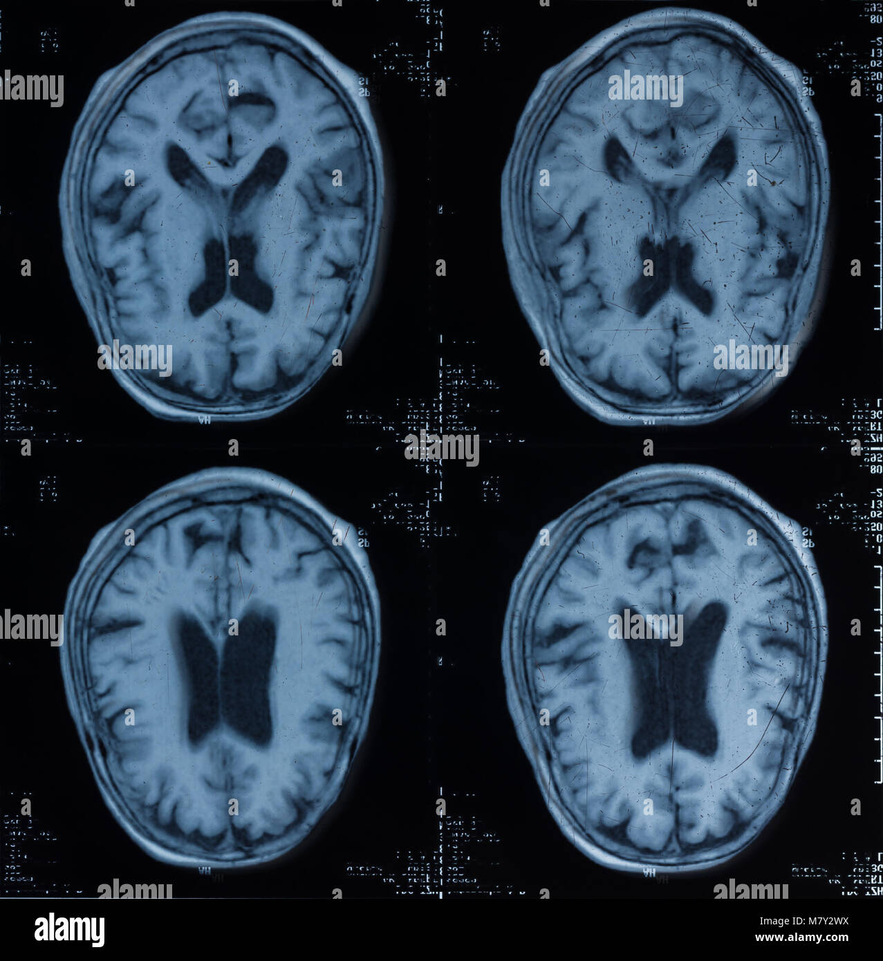 Gehirn mensch mrt -Fotos und -Bildmaterial in hoher Auflösung – Alamy