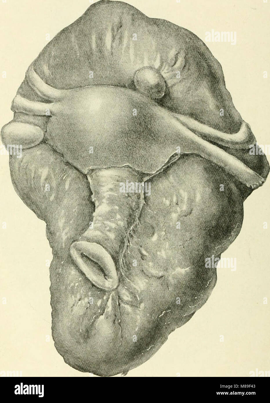 Myome und alliierten Tumoren (Myome und adenomyoma) - ihre Pathologie ...