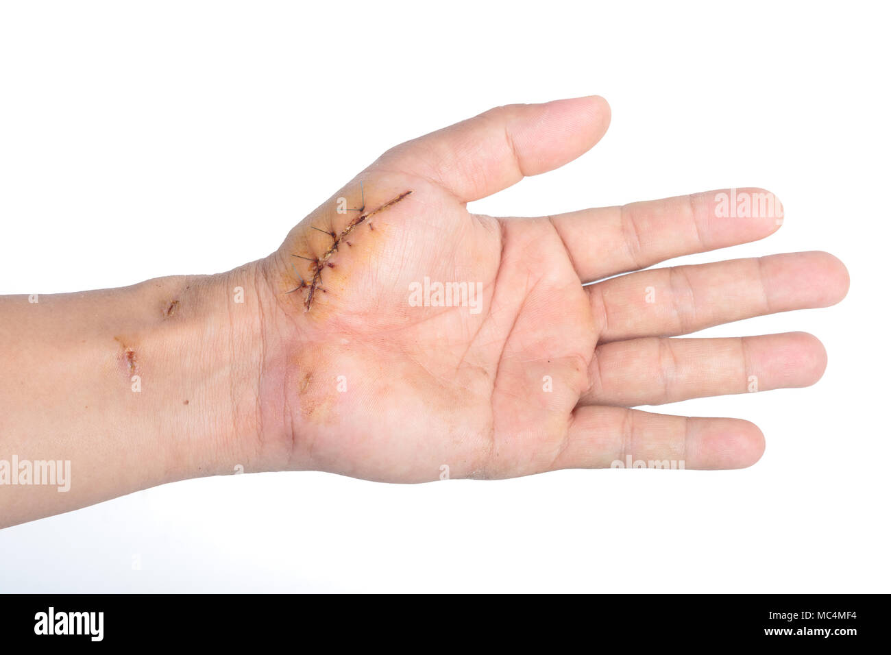 Suture wound -Fotos und -Bildmaterial in hoher Auflösung – Alamy
