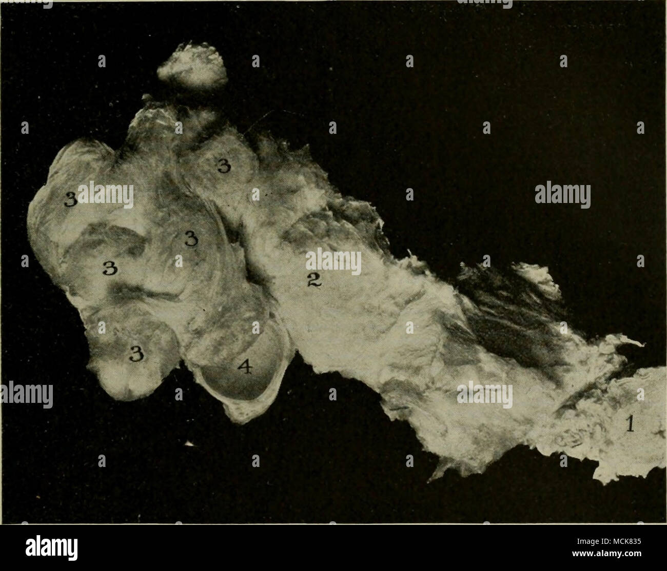 . Abb. 163 - Komplette Becken- Adhäsionen mit Gebärmutter, Cornua ...