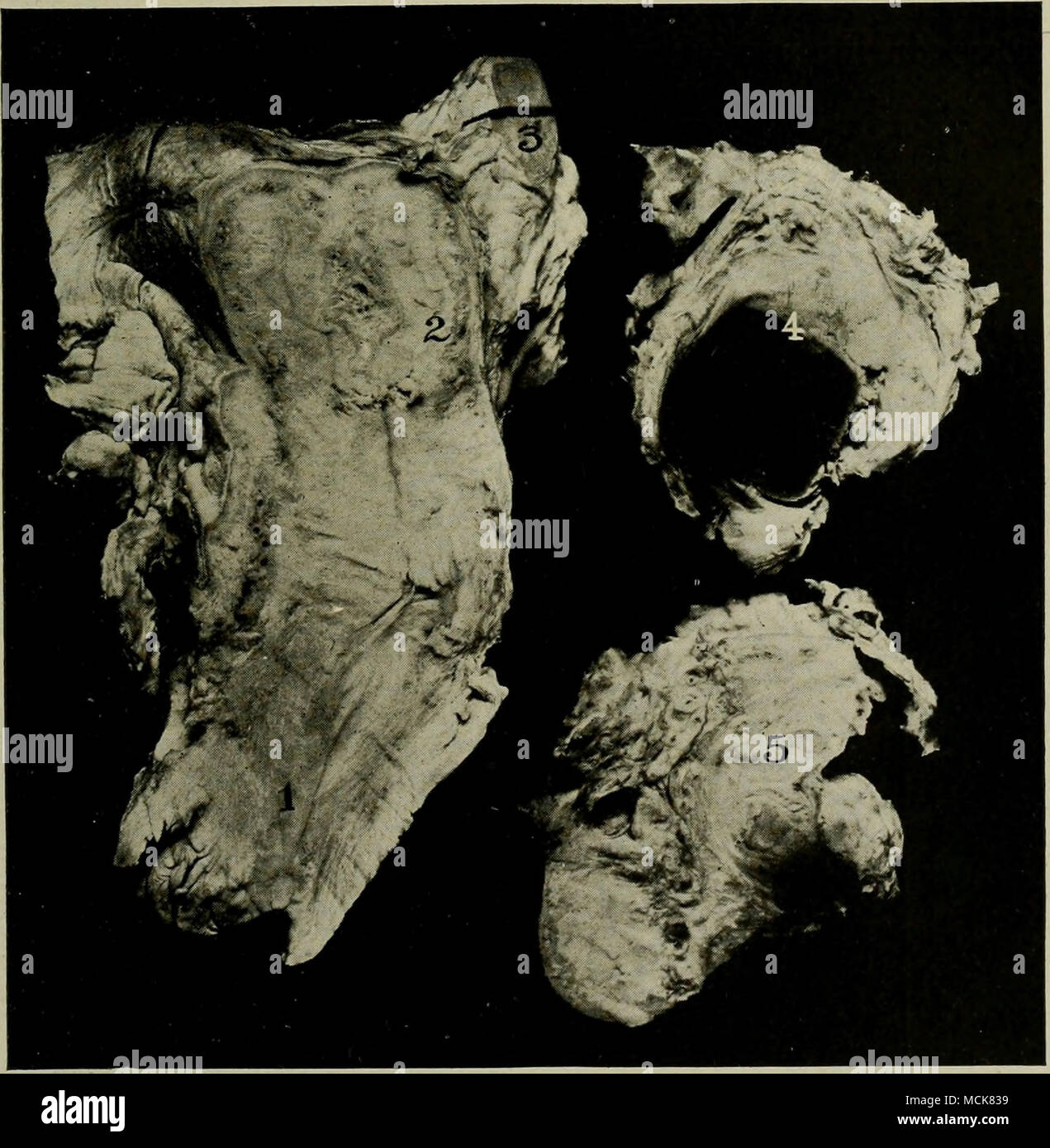 . Abb. i5S-Tubo-Ovarian Abszess mit Becken- Adhäsionen. Horizontale ...