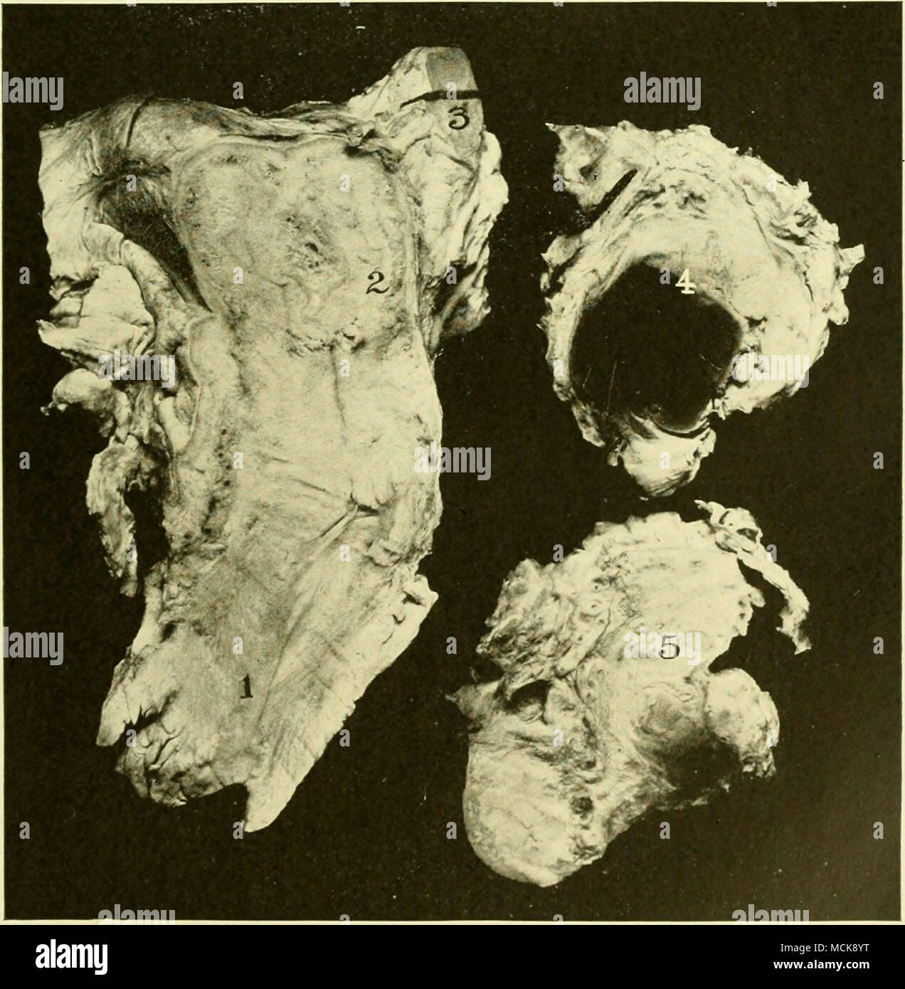 . Abb. 158 - Tubo Ovarian Abszess mit Becken- Adhäsionen. Horizontale ...