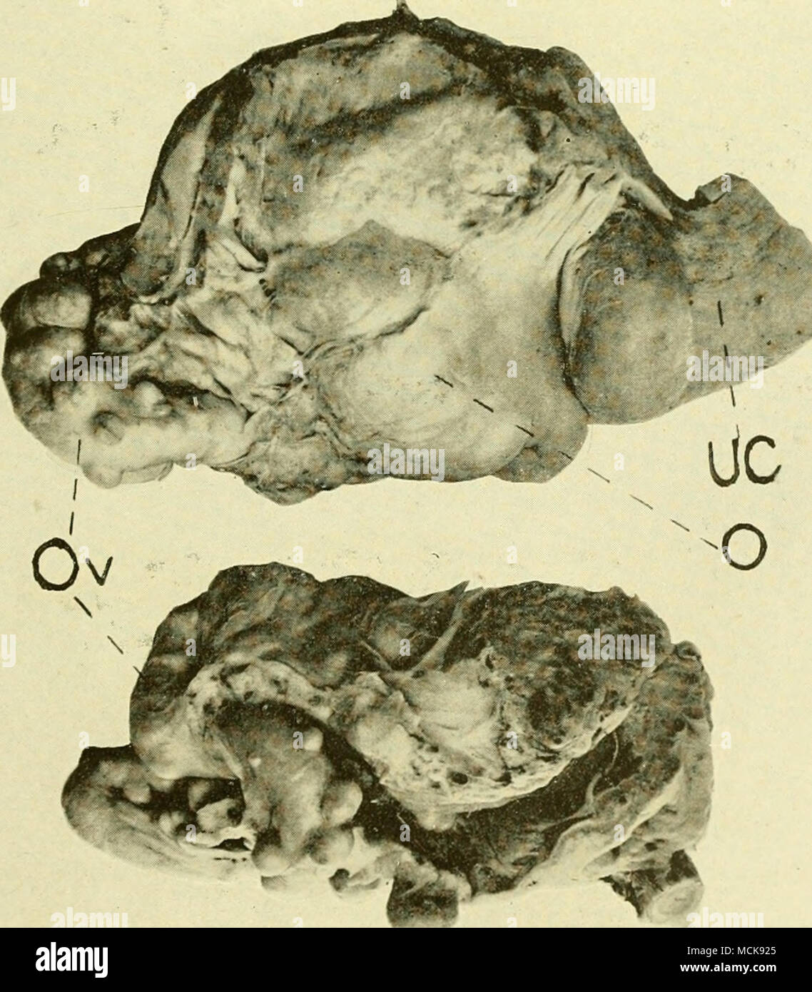 . Abb. 103 - Tuberkulose der Eierstöcke und Eileiter. Die Oviducts sind ...