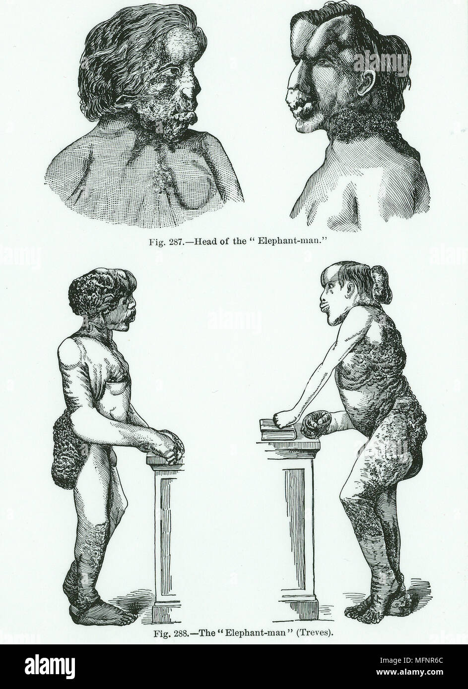 Anomalien kuriositäten der medizin -Fotos und -Bildmaterial in hoher ...