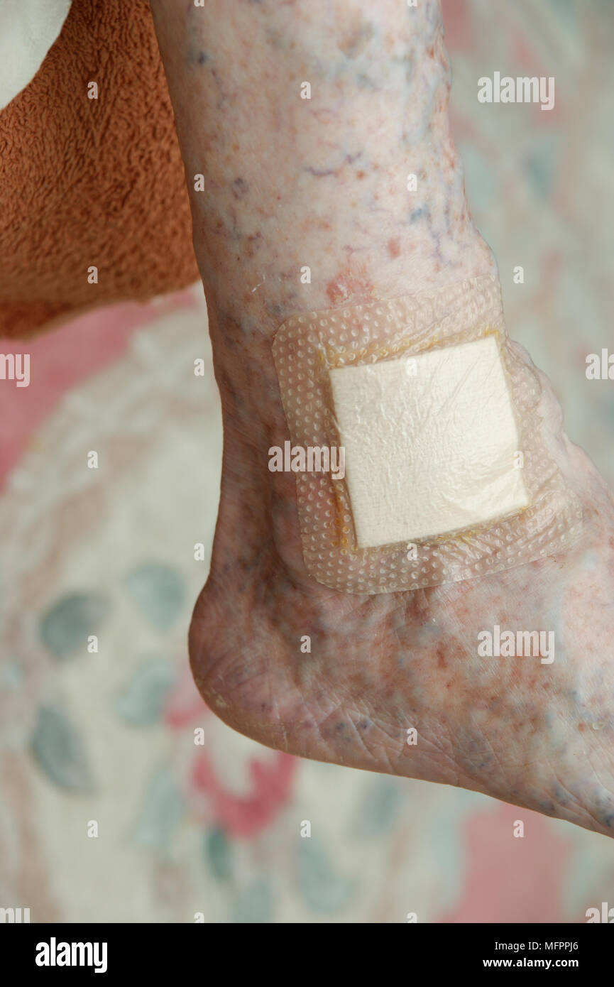 Infizierte wunde behandeln -Fotos und -Bildmaterial in hoher Auflösung ...