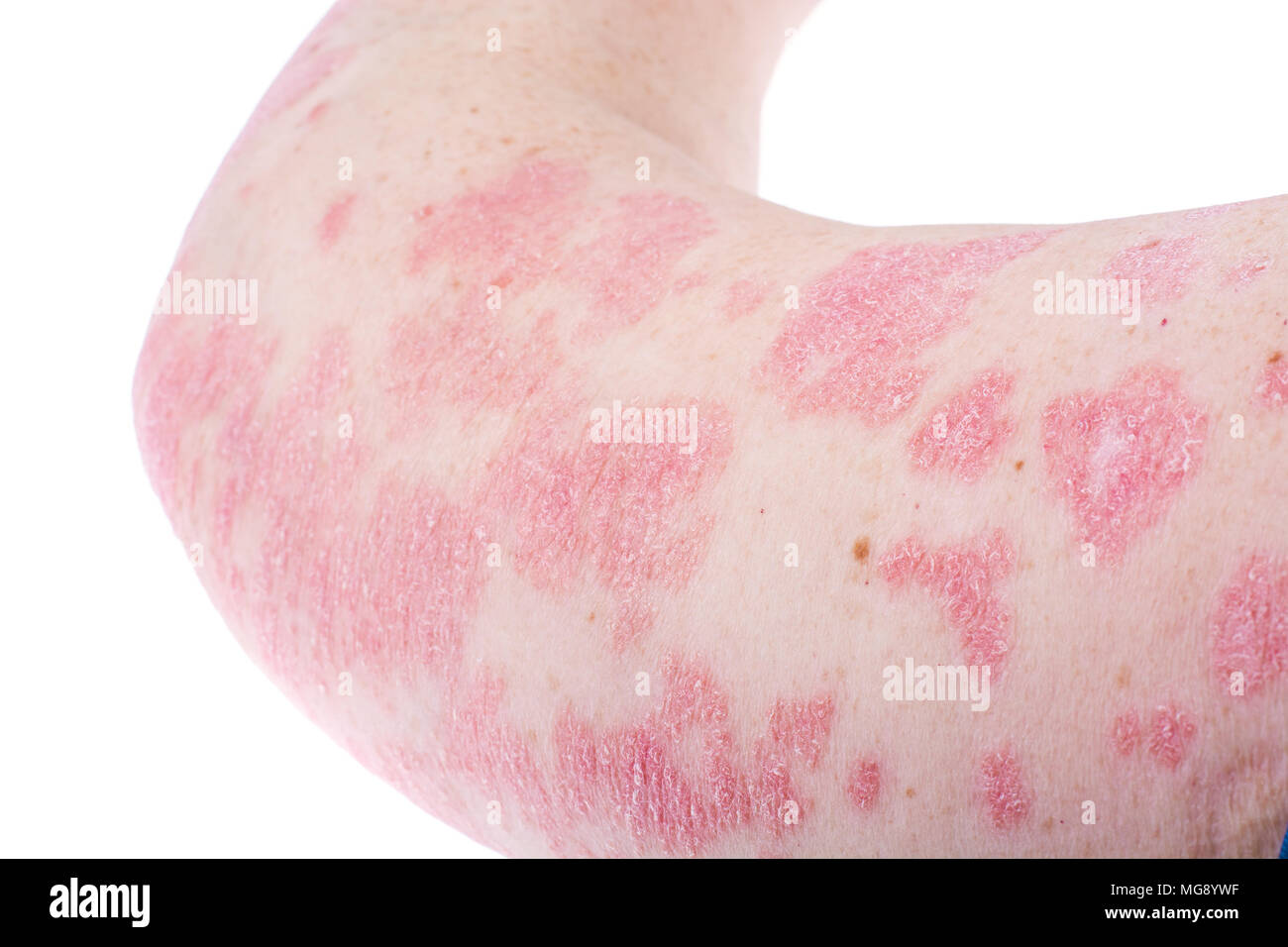 Dermatologische Hautkrankheit Psoriasis, stärker auf Ellenbogen, Hand ...