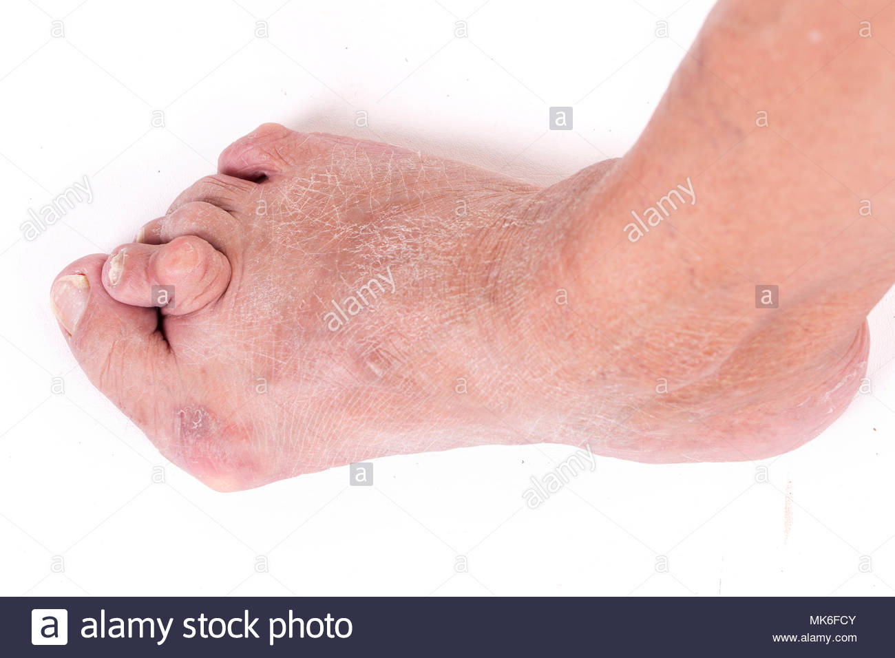 Hallux Valgus Stockfotos & Hallux Valgus Bilder - Alamy